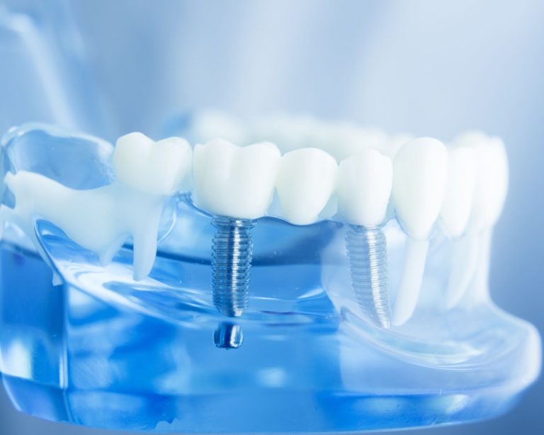 PRÓTESES REMOVÍVEIS E FIXAS - IOB Odontologia
